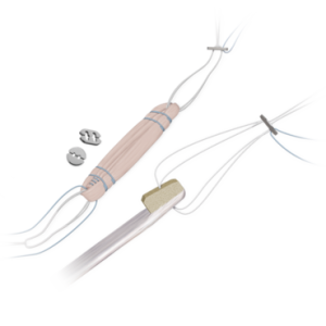 ACL TightRope – Biocells Surgical
